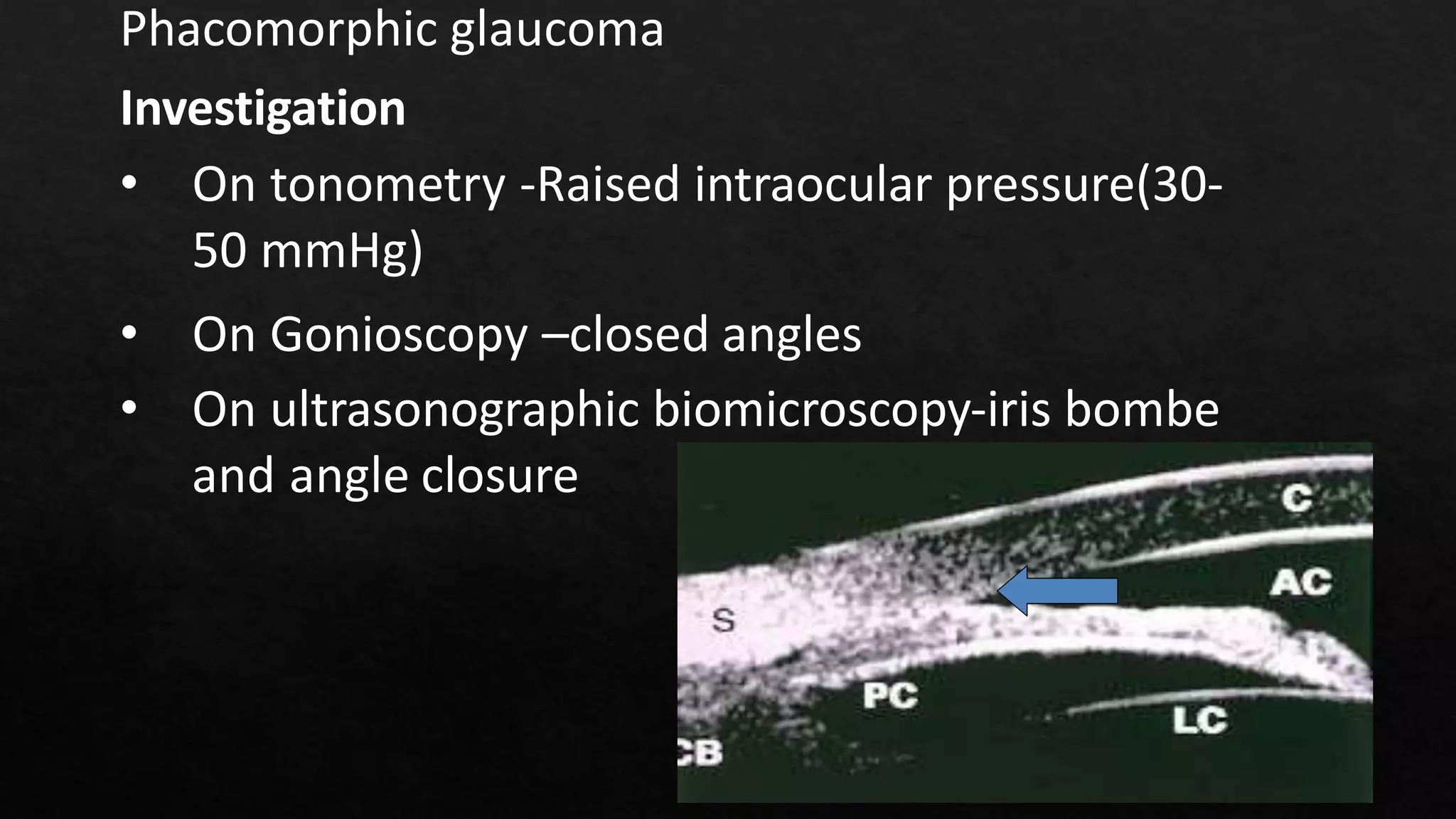 Lens induced glaucoma - DR ARNAV | PPTX