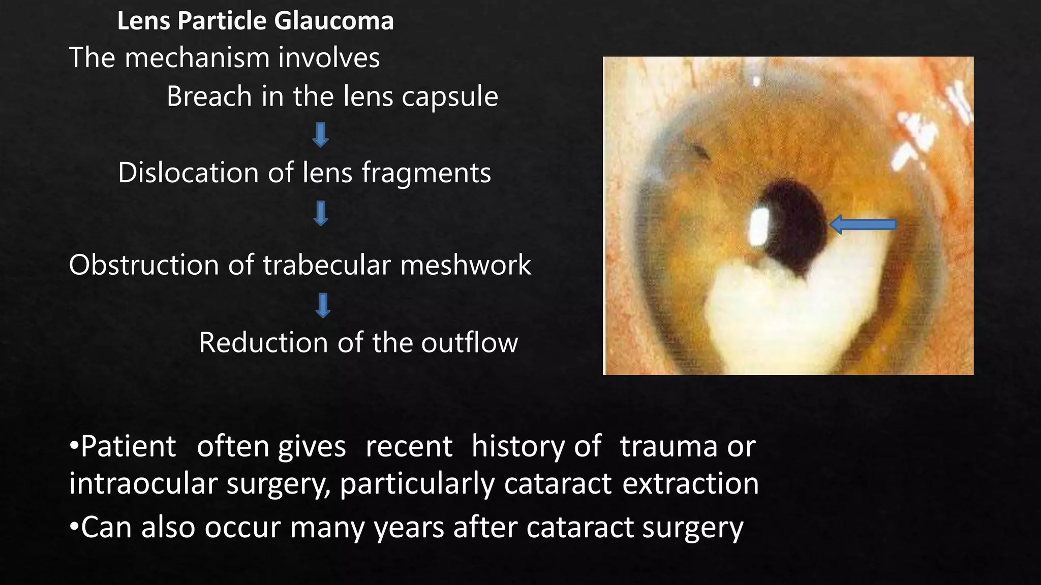 Lens induced glaucoma - DR ARNAV | PPTX