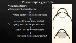 Lens induced glaucoma - DR ARNAV | PPTX