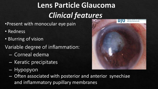 Lens induced glaucoma - DR ARNAV | PPTX