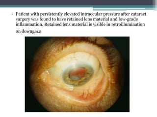 Lens Induced Uveitis | PPTX
