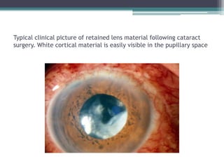 Lens Induced Uveitis | PPTX