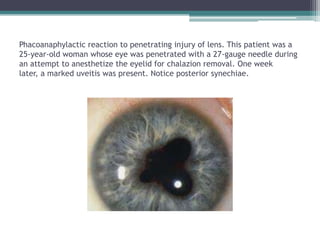Lens Induced Uveitis | PPTX