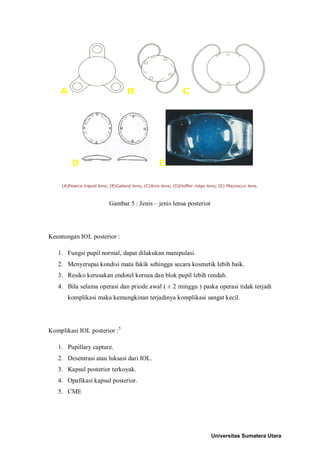 LENSA INTRA OKULER 2.pdf