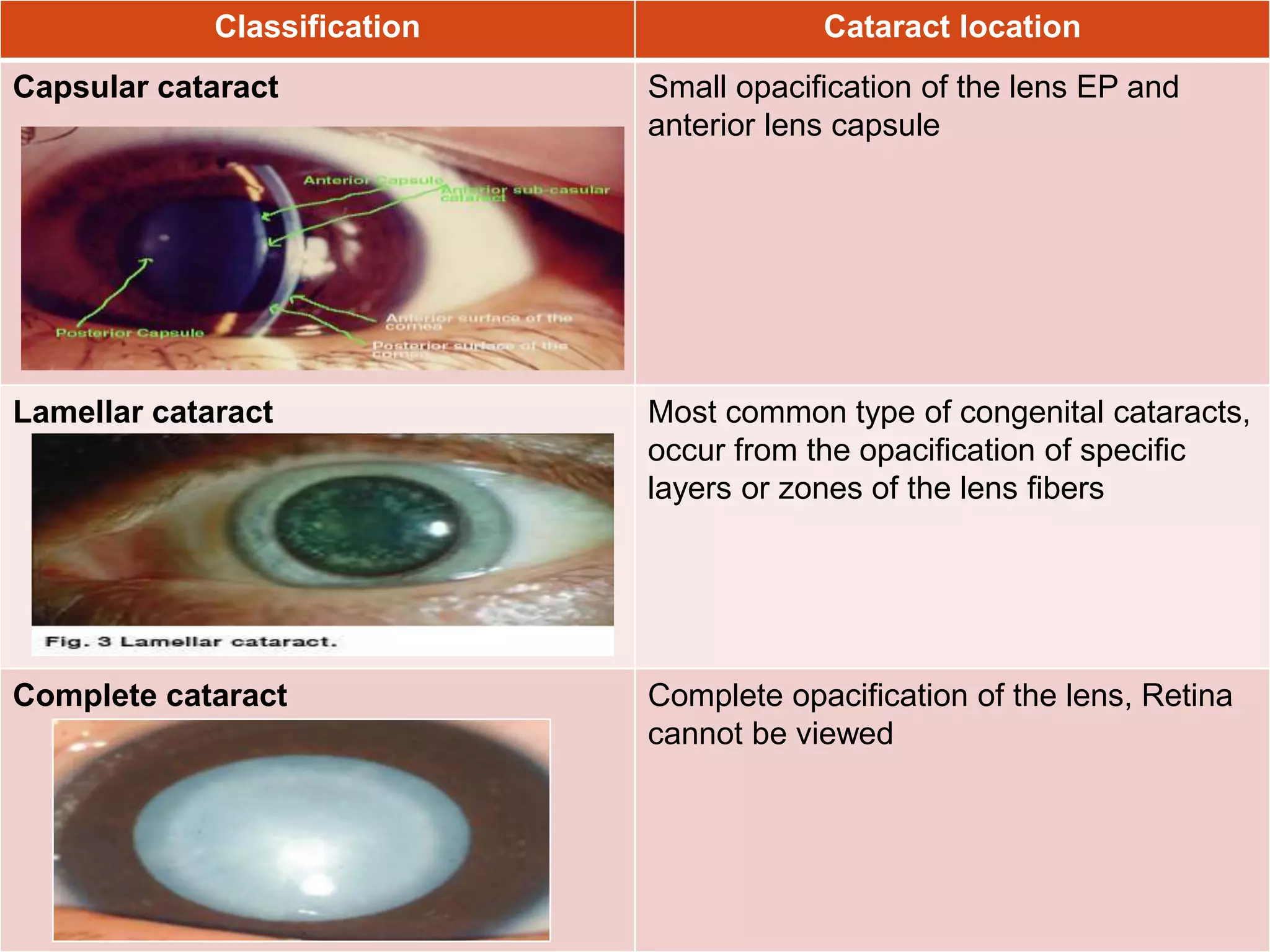 Lens and cataract | PPTX | Eye and Vision Conditions | Diseases and ...