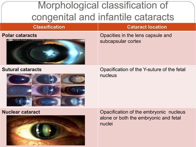 Lens and cataract | PPTX | Eye and Vision Conditions | Diseases and ...