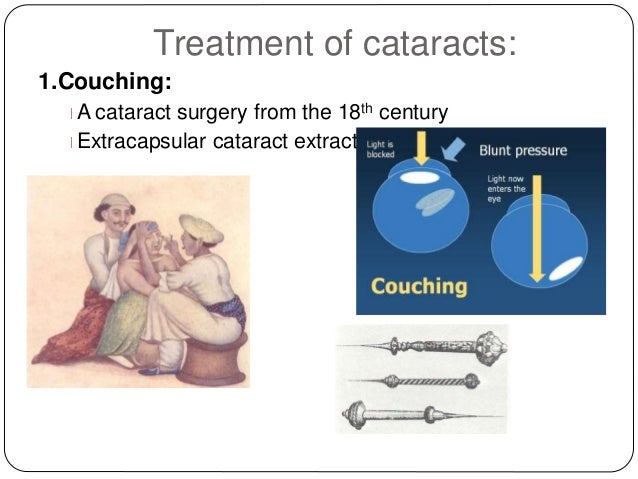 Extracapsular Cataract Extraction Illustration