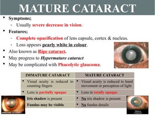 Lens and Cataract.GRB YTBGR ETF3R 3RGBFG | PPTX