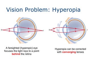 Lenses and the human eye | PPT