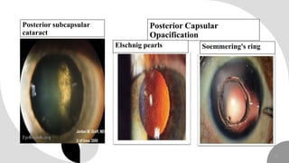 LENS AND VITEROUS ANATOMY .pptx