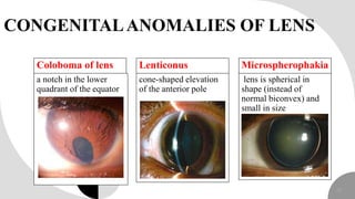 LENS AND VITEROUS ANATOMY .pptx