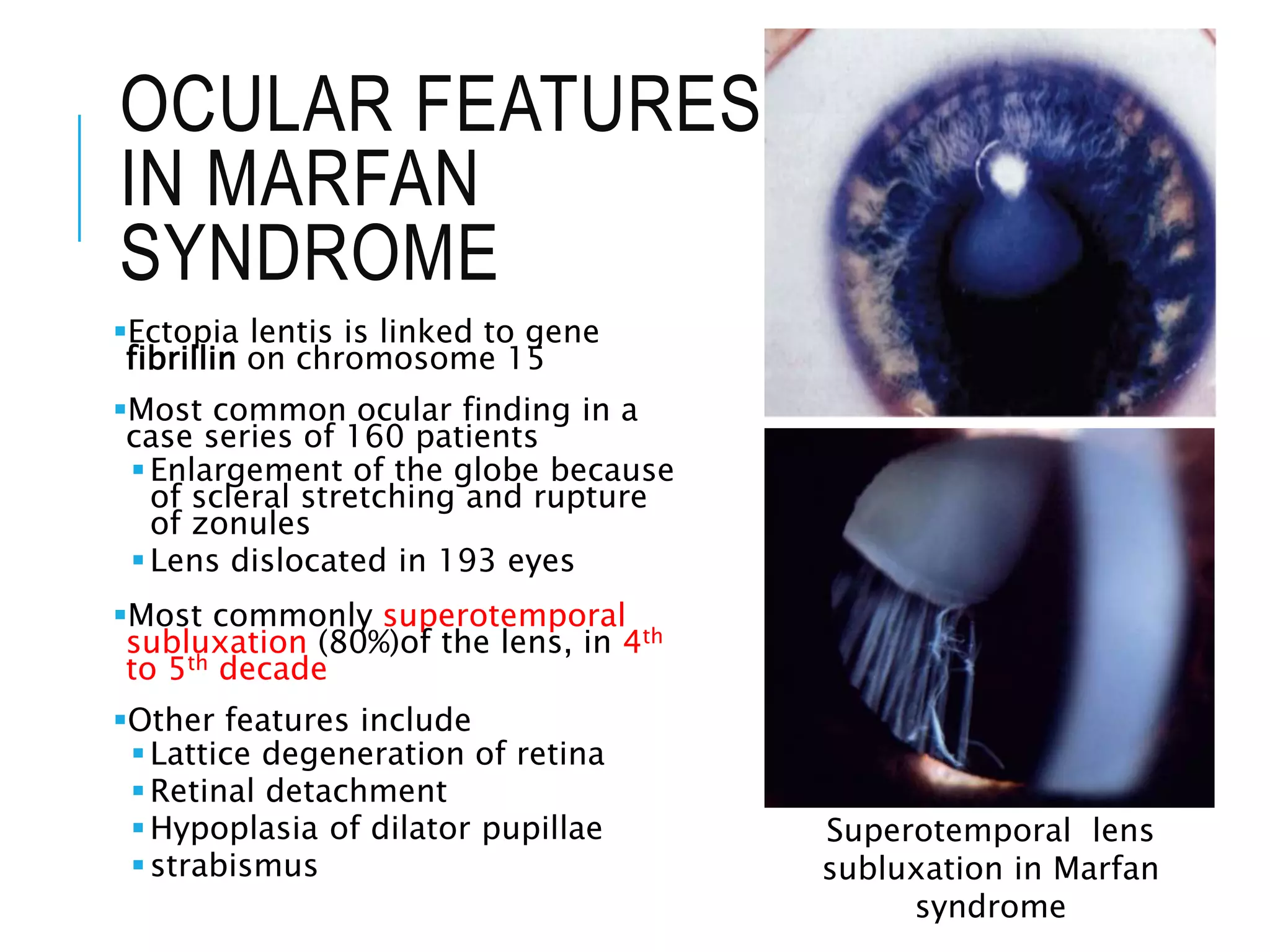 Lens induced glaucoma | PPTX