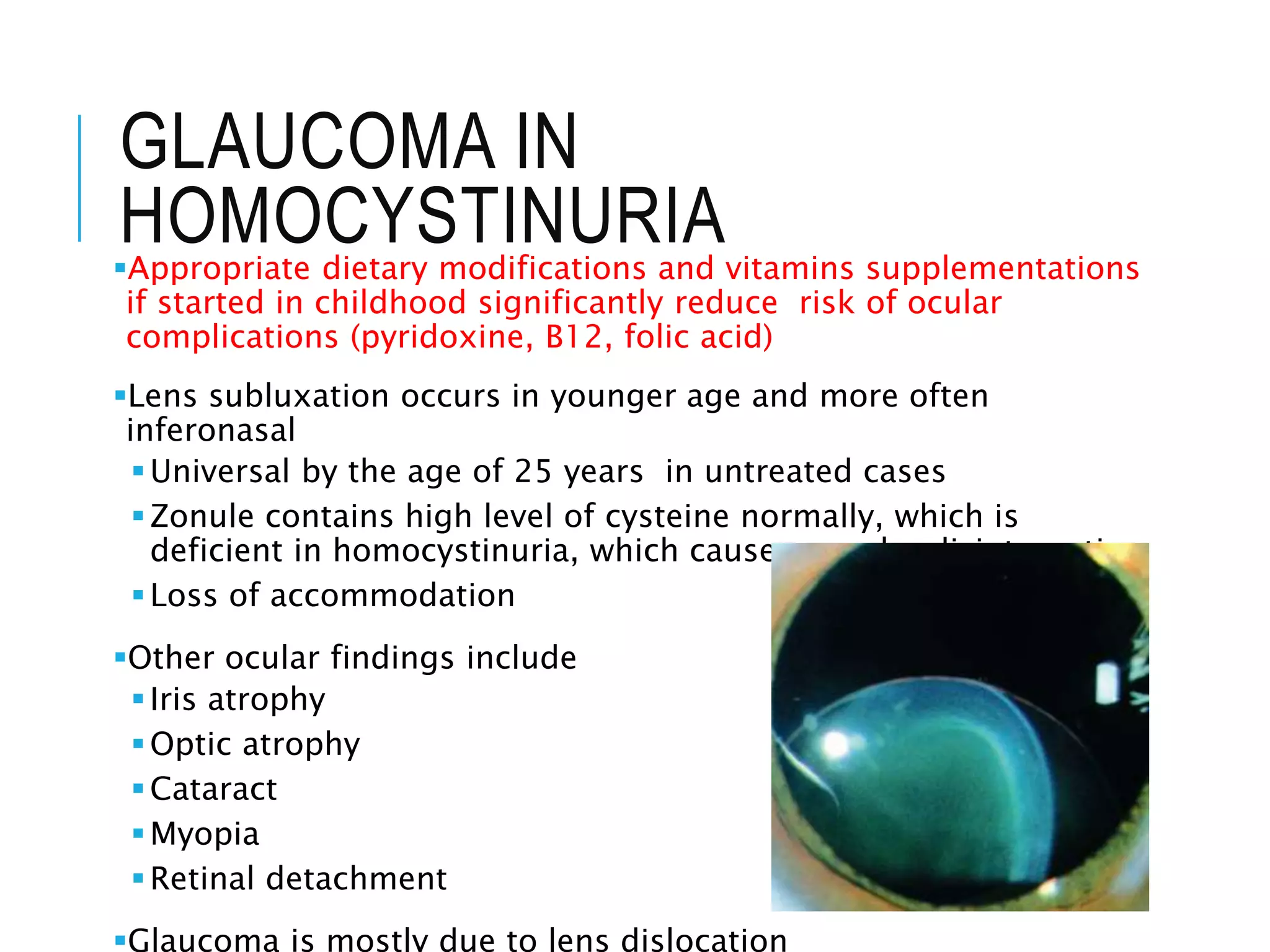 Lens induced glaucoma | PPTX