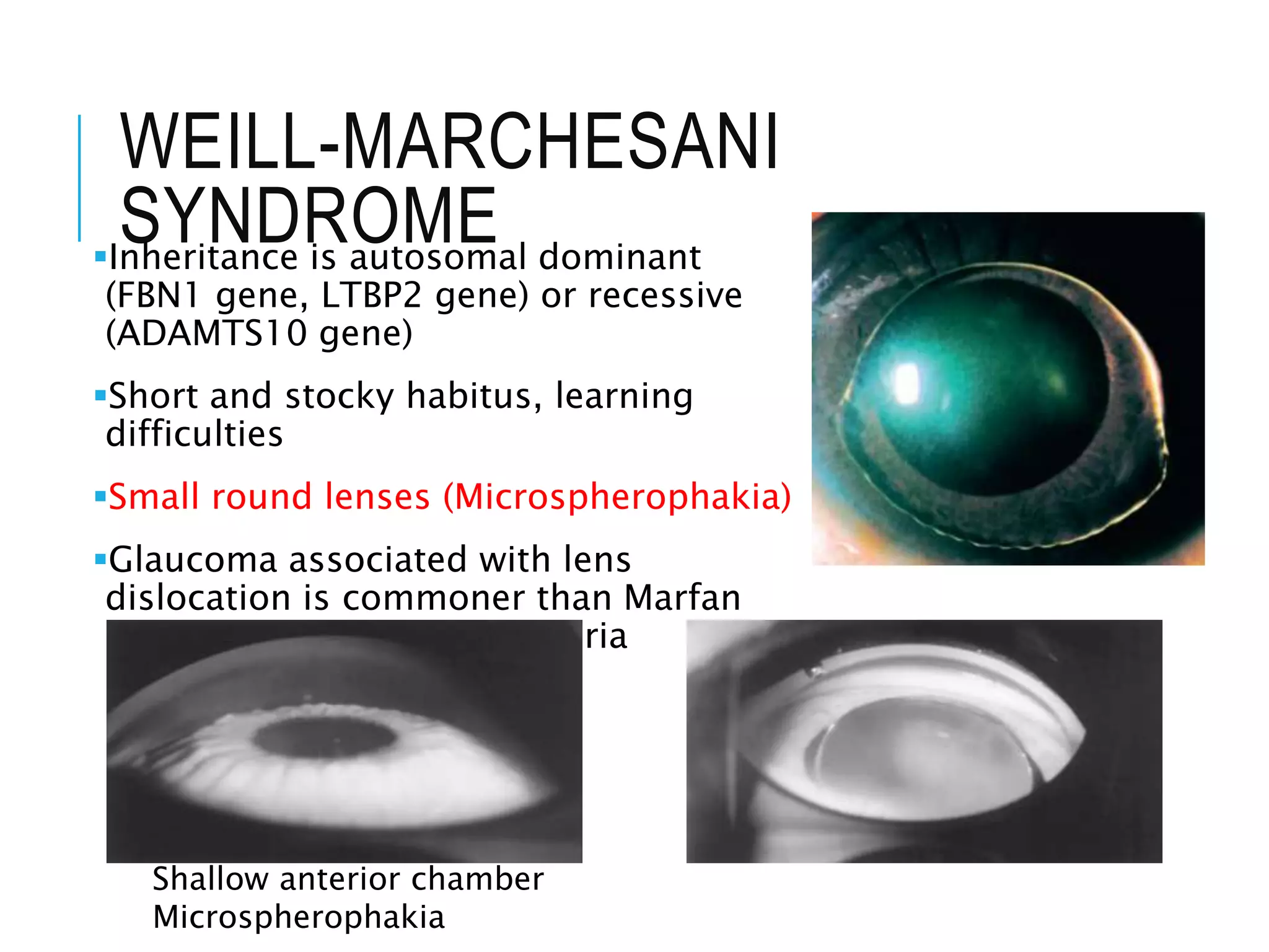 Lens induced glaucoma | PPTX