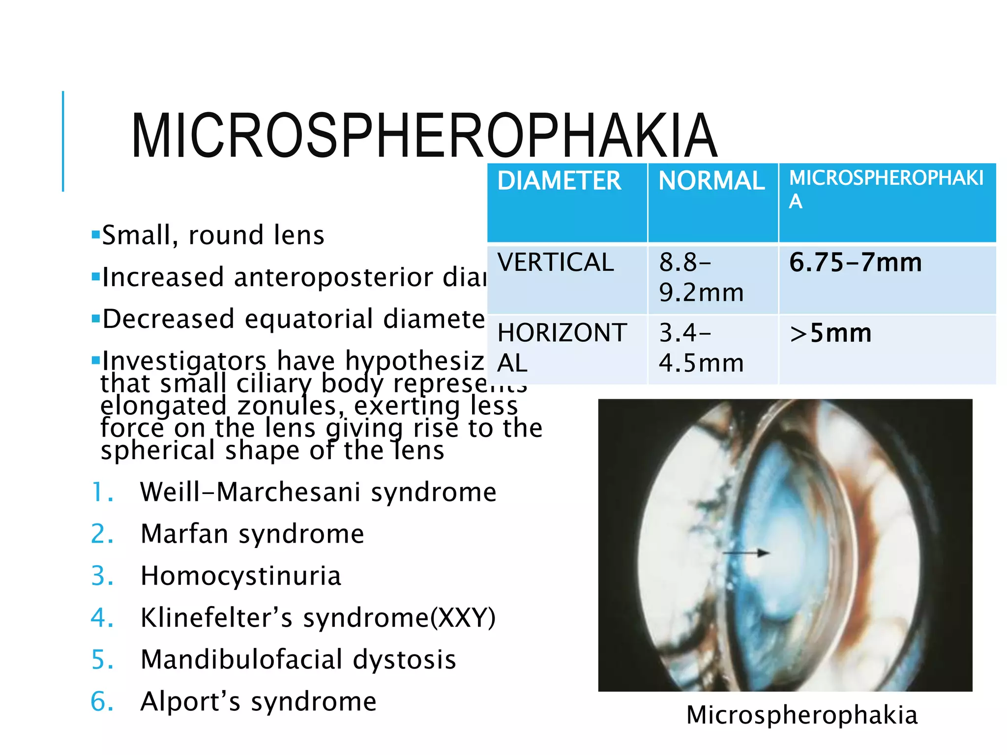 Lens induced glaucoma | PPTX