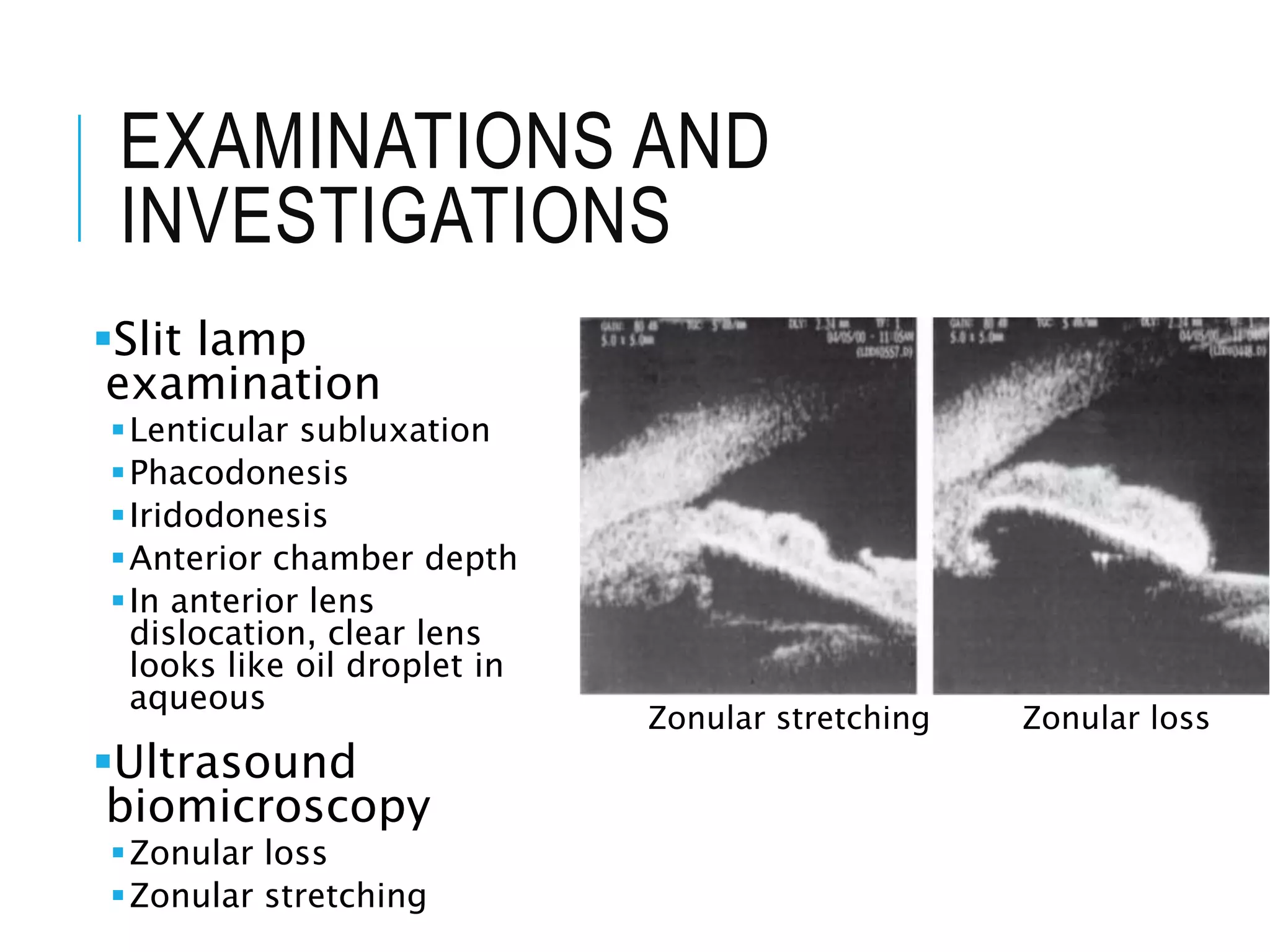 Lens induced glaucoma | PPTX