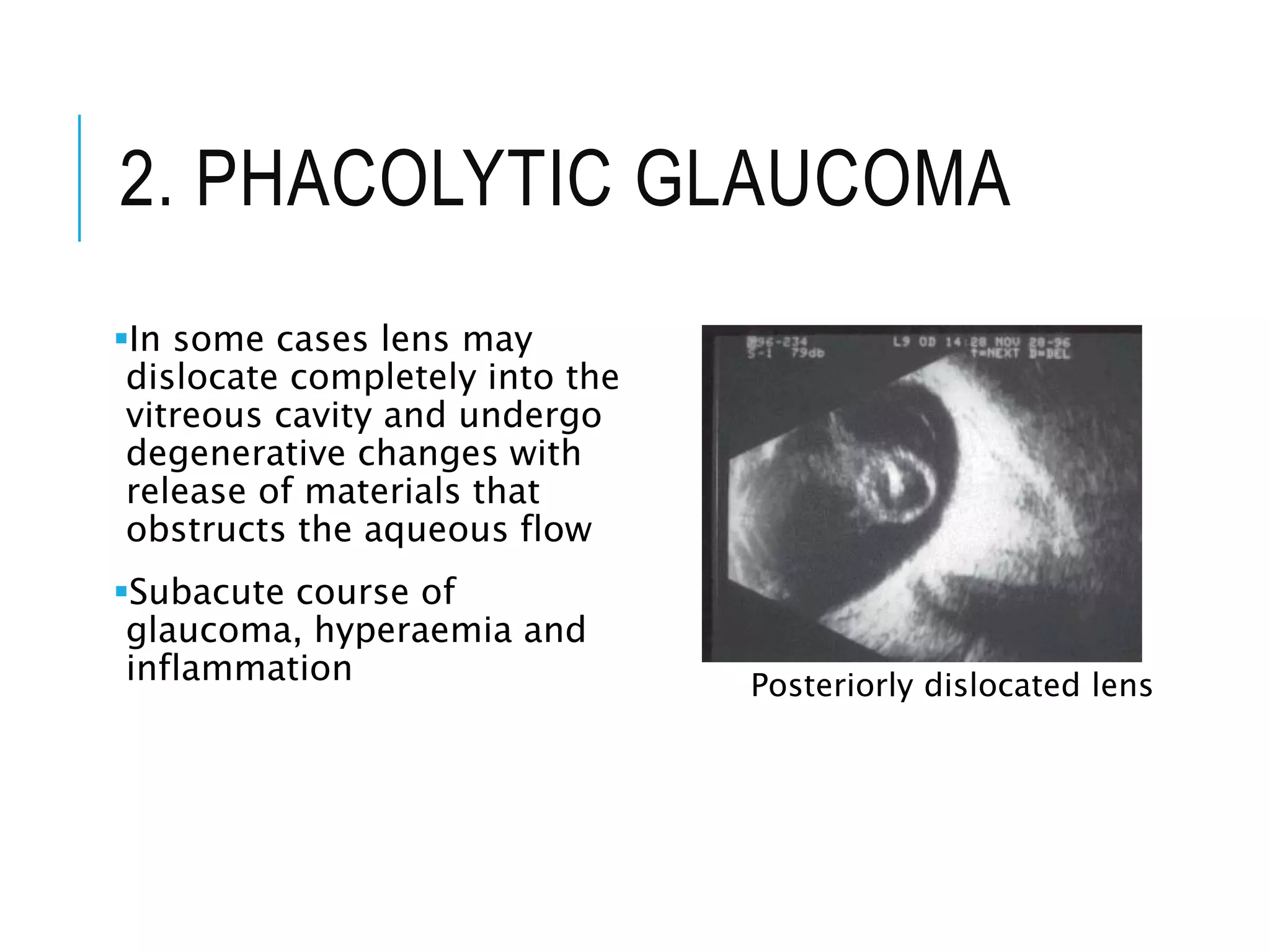 Lens induced glaucoma | PPTX