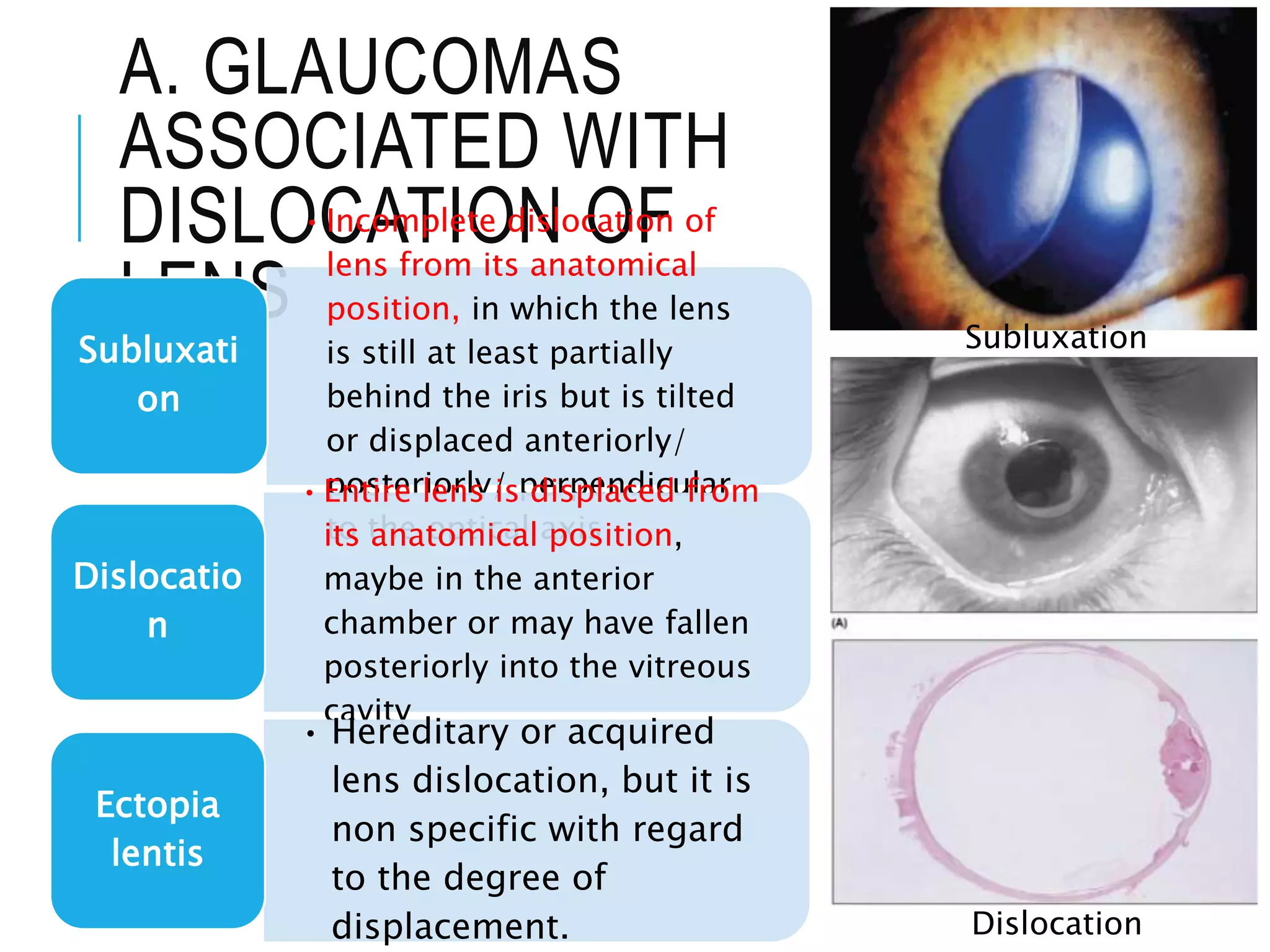 Lens induced glaucoma | PPTX