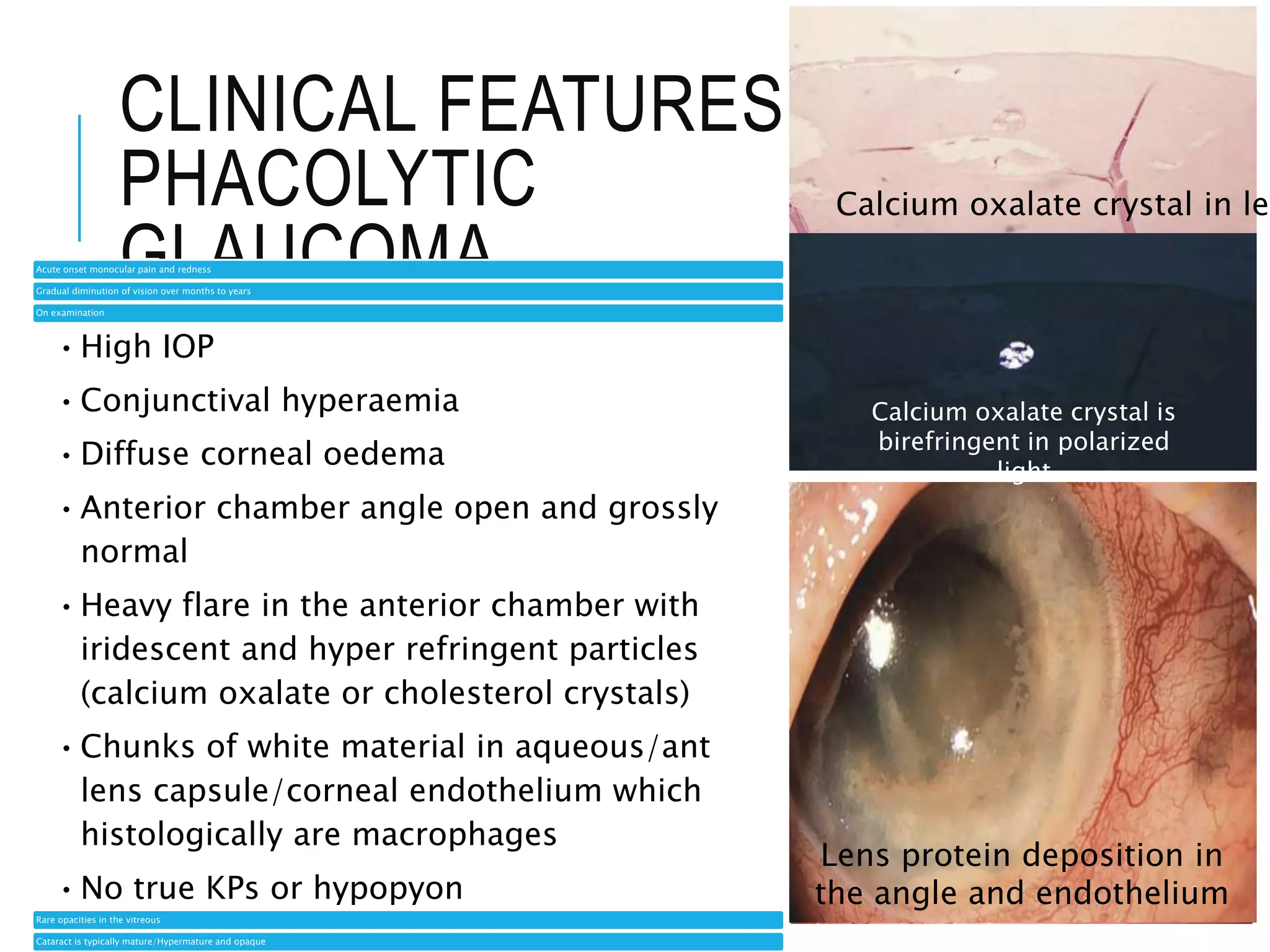 Lens induced glaucoma | PPTX