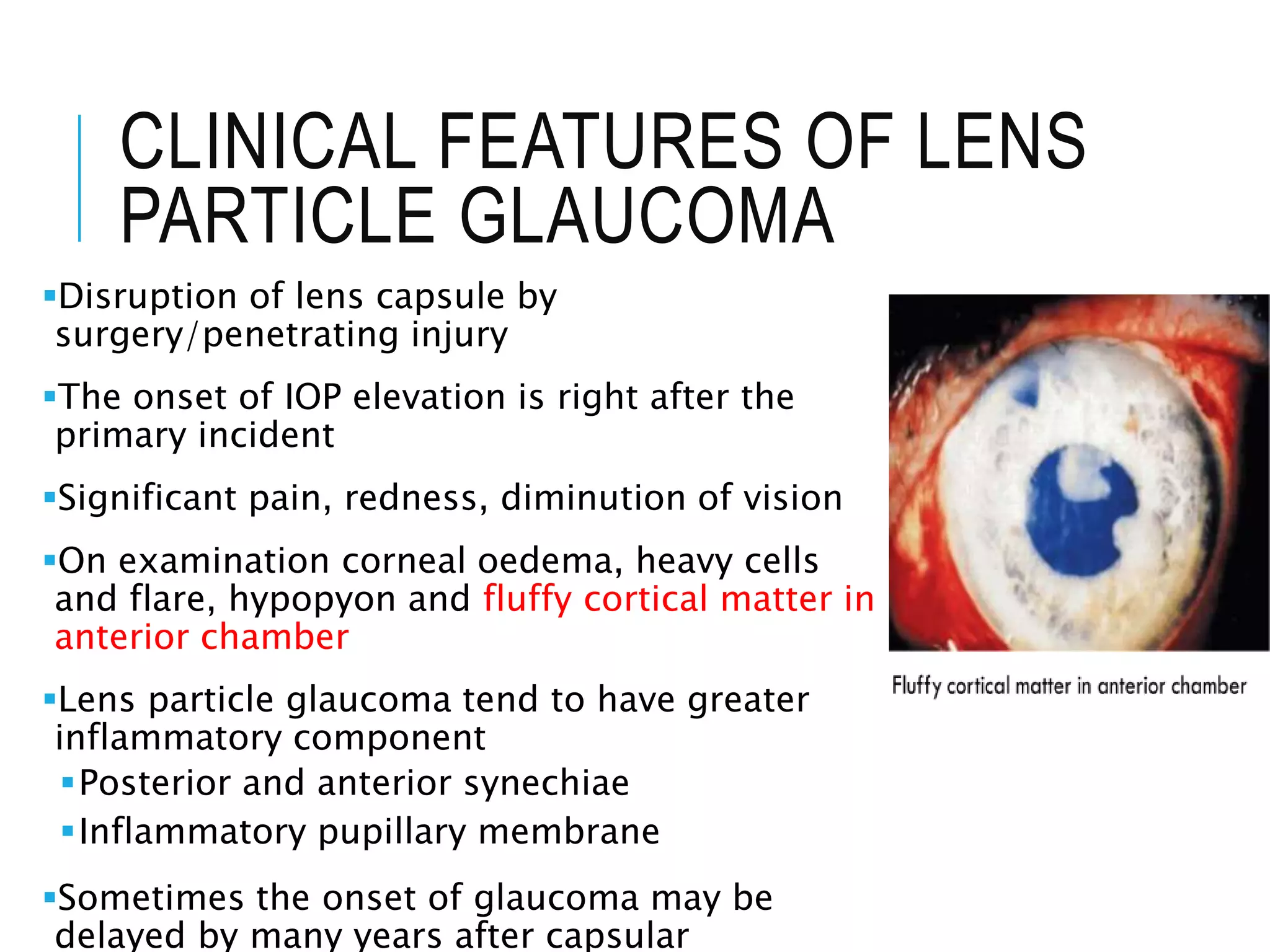 Lens induced glaucoma | PPTX