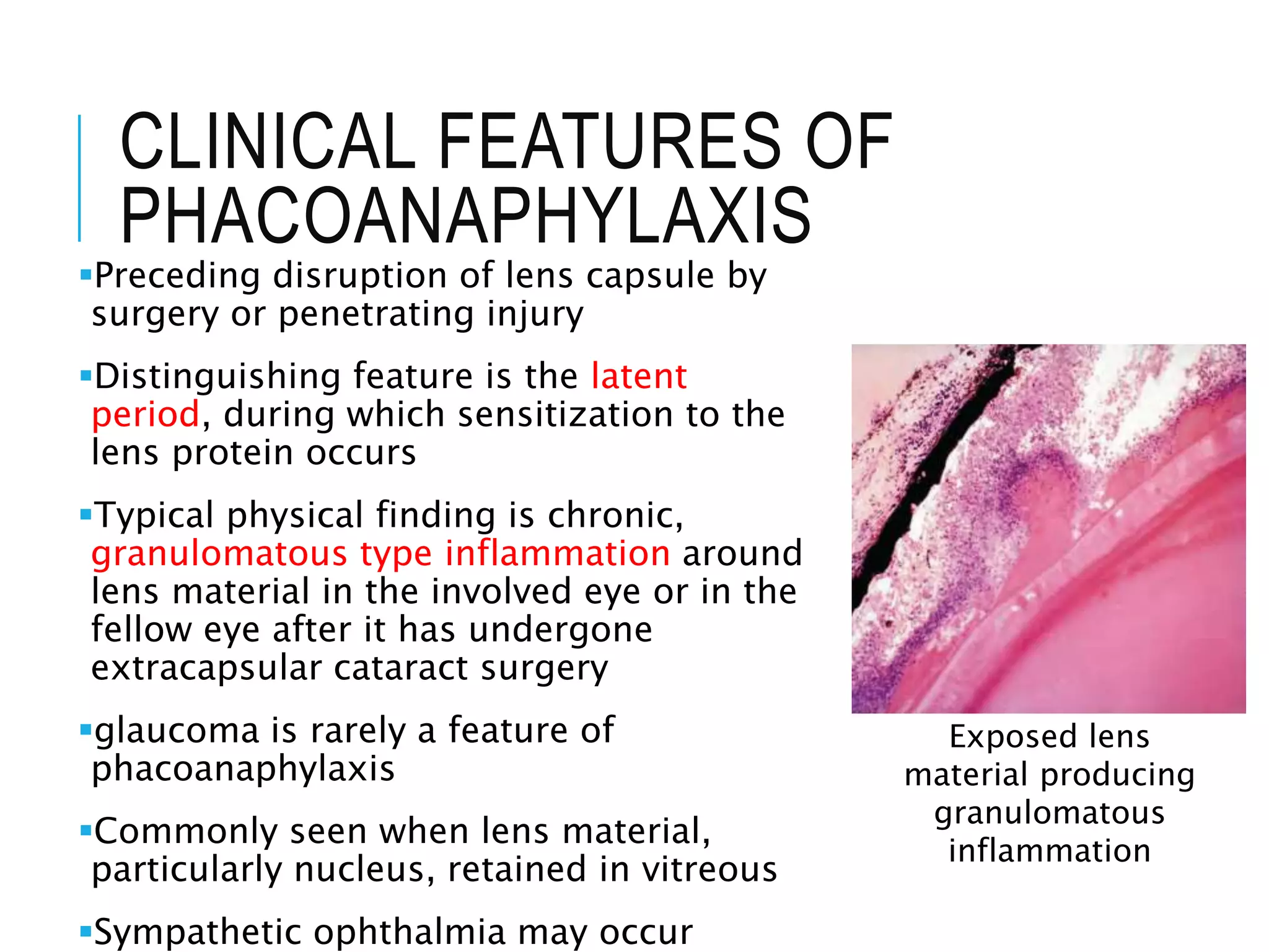 Lens induced glaucoma | PPTX