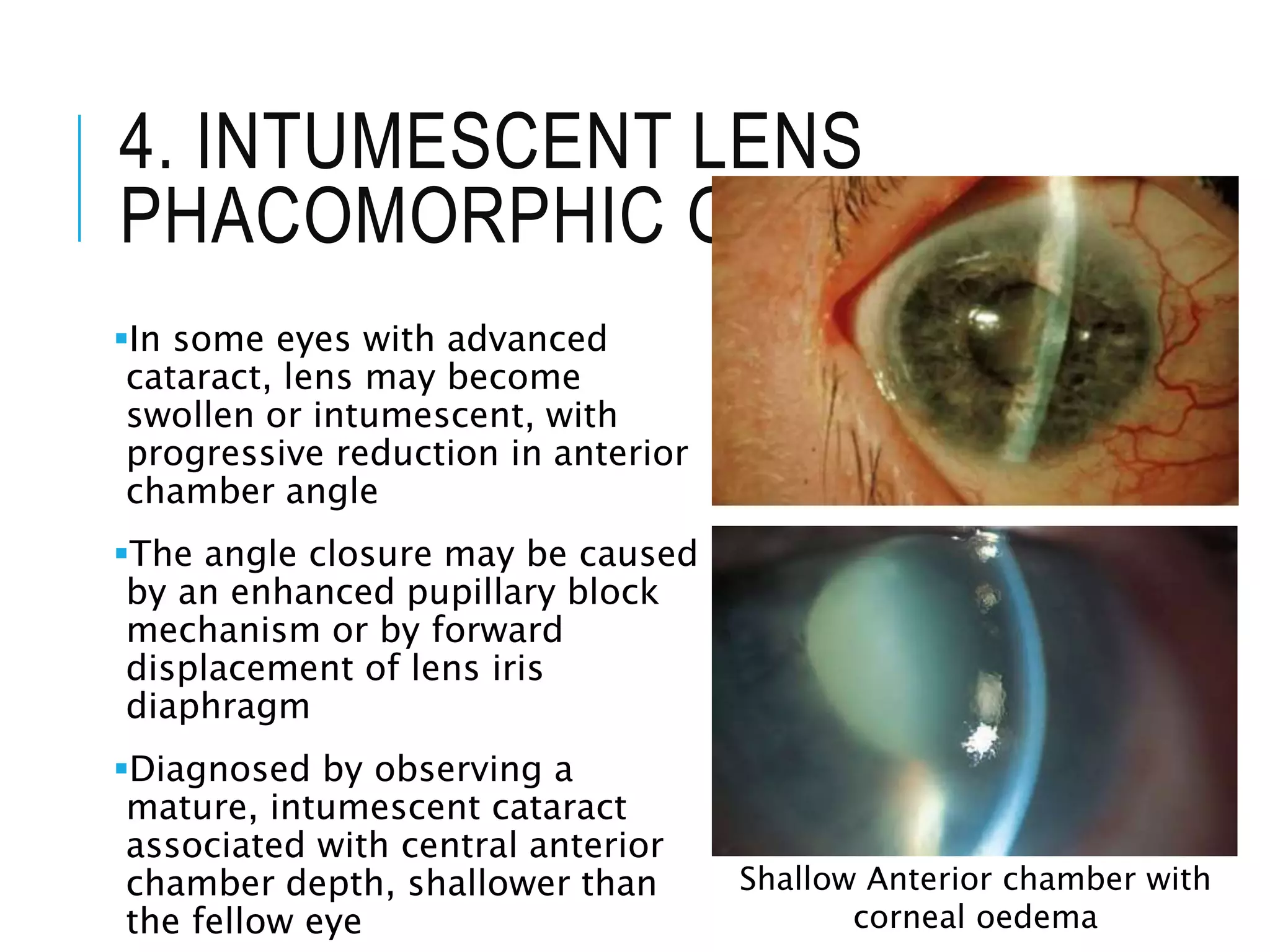 Lens induced glaucoma | PPTX