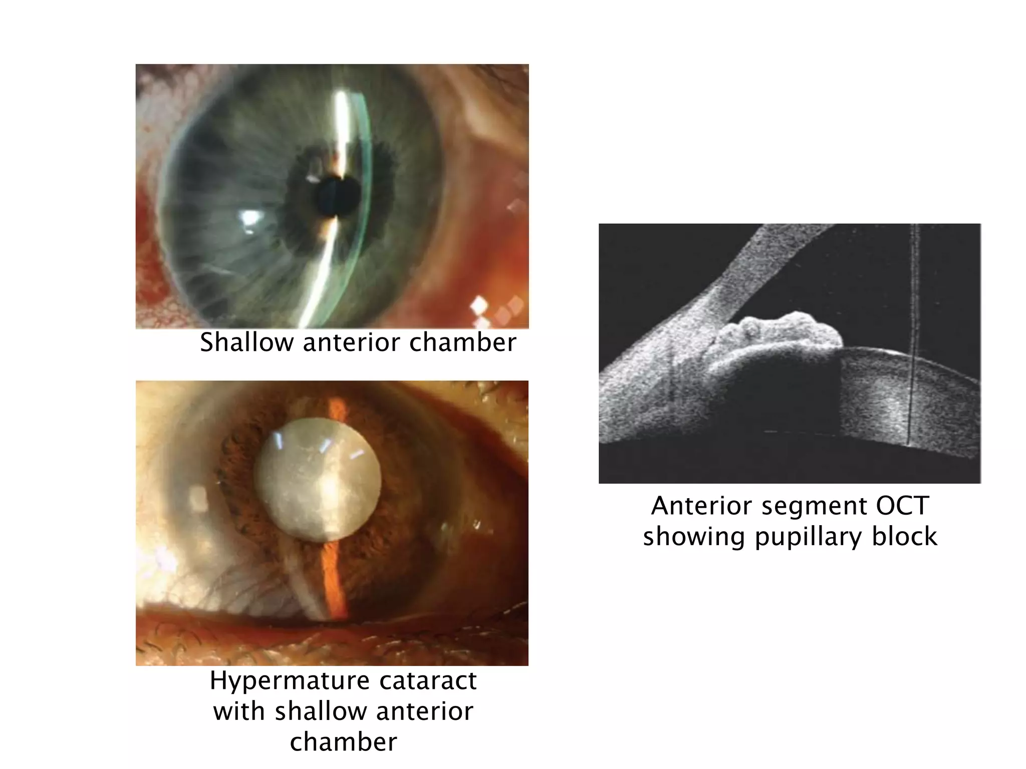 Lens induced glaucoma | PPTX