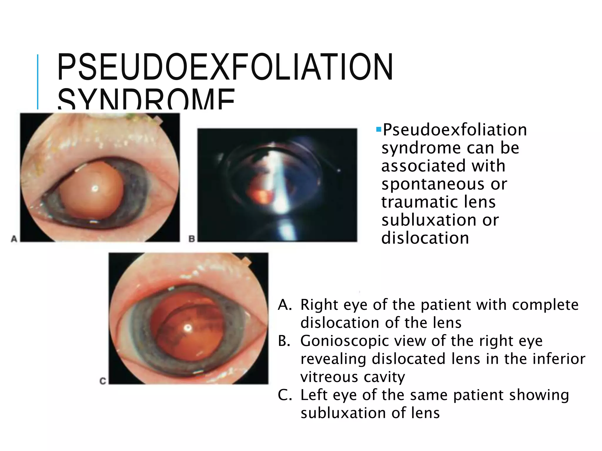 Lens induced glaucoma | PPTX