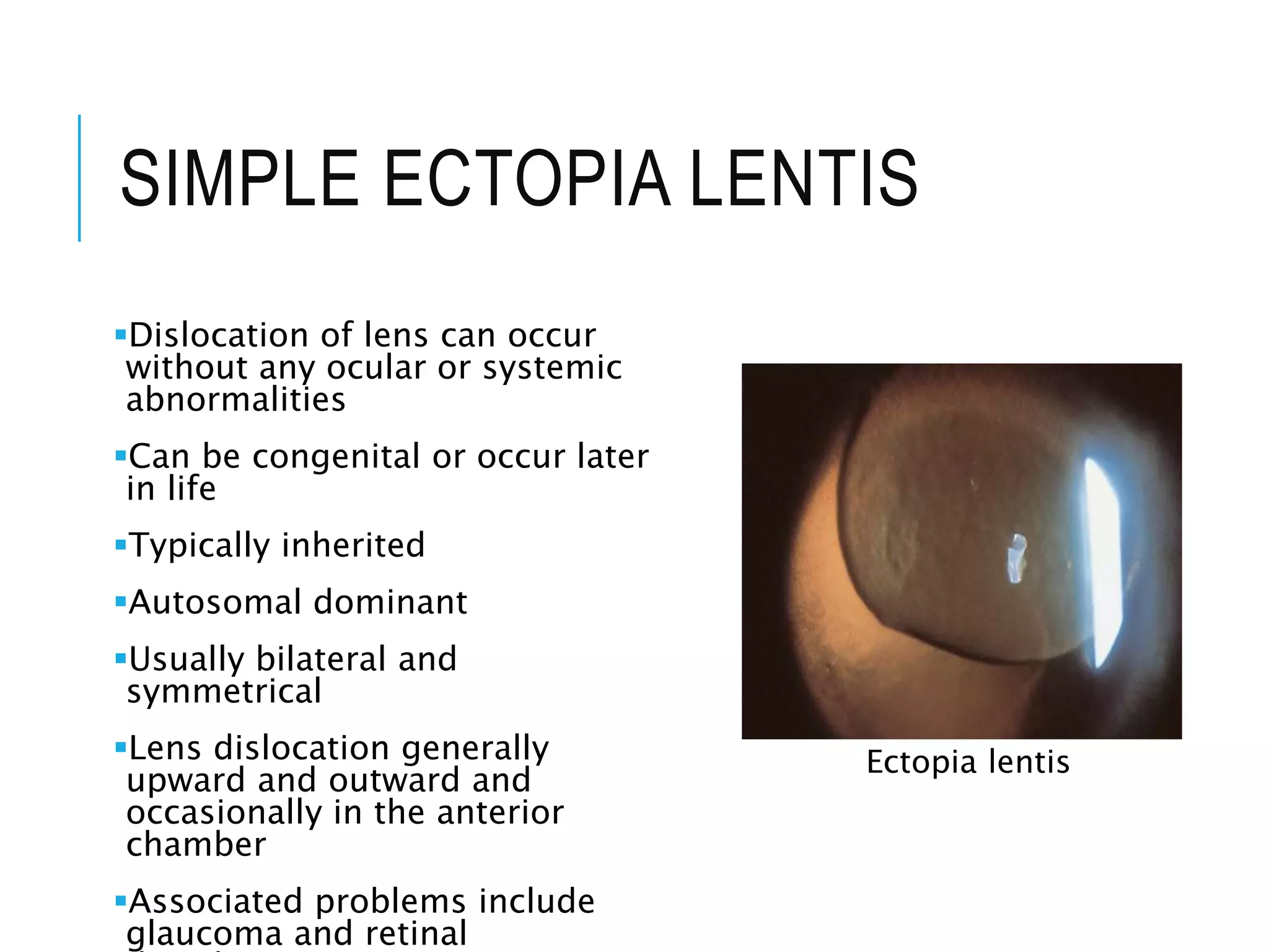 Lens induced glaucoma | PPTX