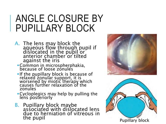 Lens induced glaucoma | PPTX | Eye and Vision Conditions | Diseases and ...