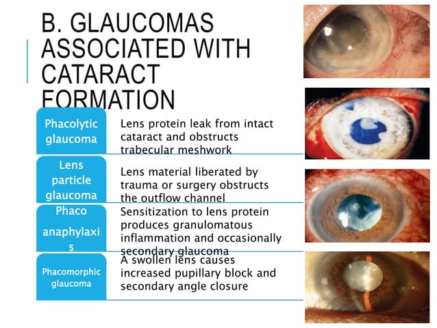 Lens induced glaucoma | PPTX | Eye and Vision Conditions | Diseases and ...