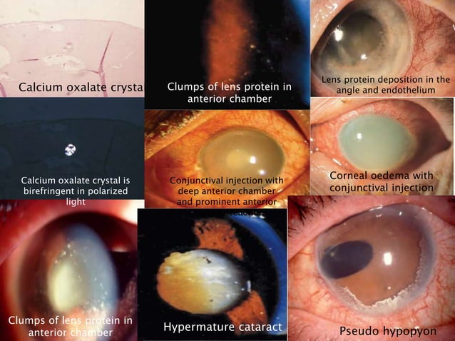 Lens induced glaucoma | PPTX | Eye and Vision Conditions | Diseases and ...