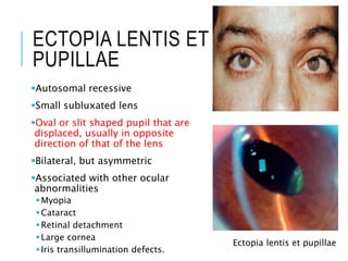 Lens induced glaucoma | PPTX