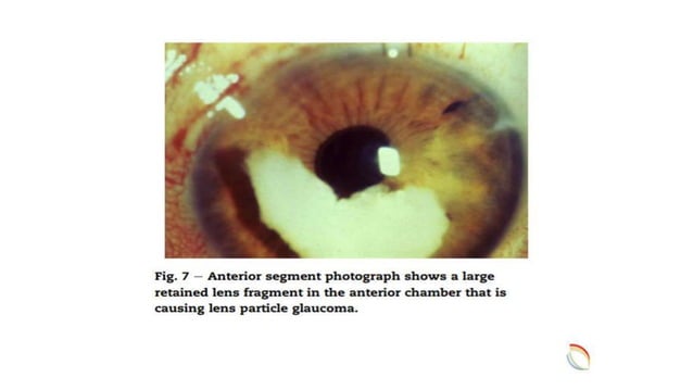 Lens induced glaucoma. | PPTX
