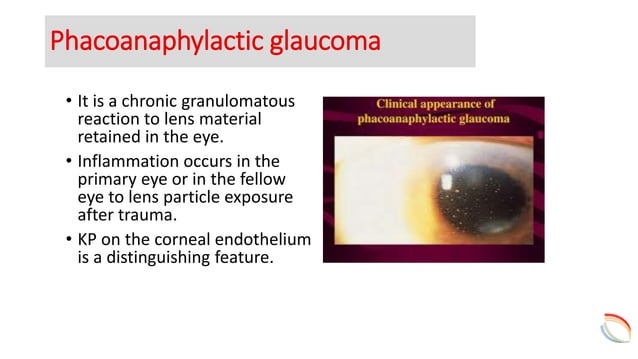Lens induced glaucoma. | PPTX