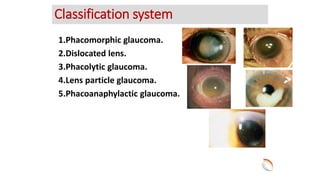 Lens induced glaucoma. | PPTX