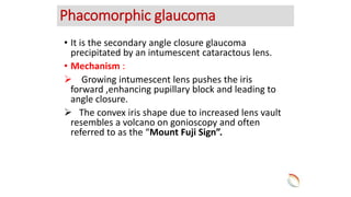 Lens induced glaucoma. | PPTX
