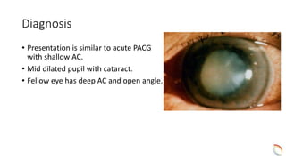 Lens induced glaucoma. | PPTX