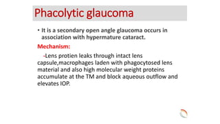 Lens induced glaucoma. | PPTX