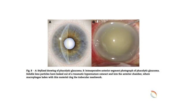 Lens induced glaucoma. | PPTX
