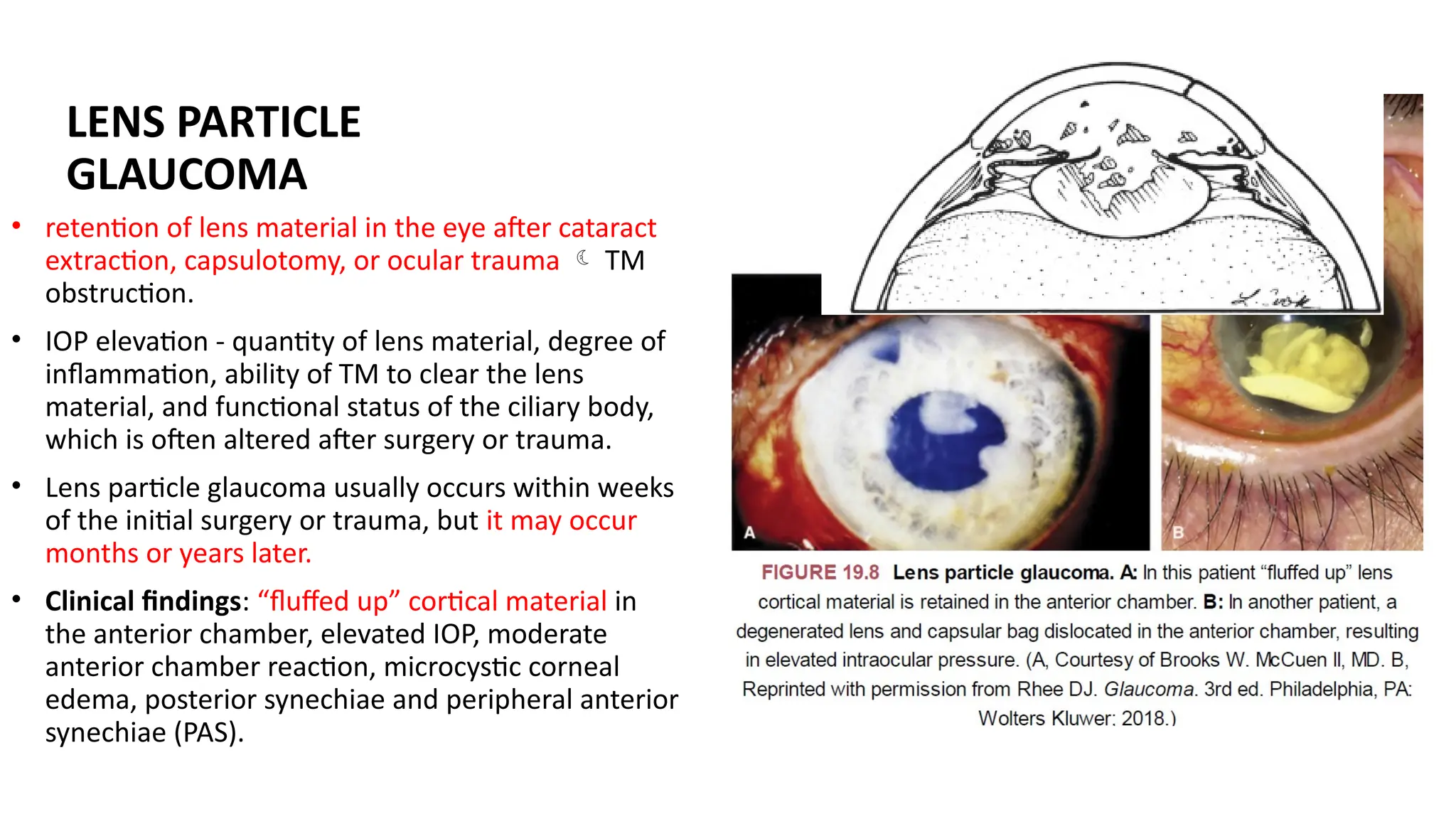 LENS INDUCED GLAUCOMA for Ophthalmology.pptx