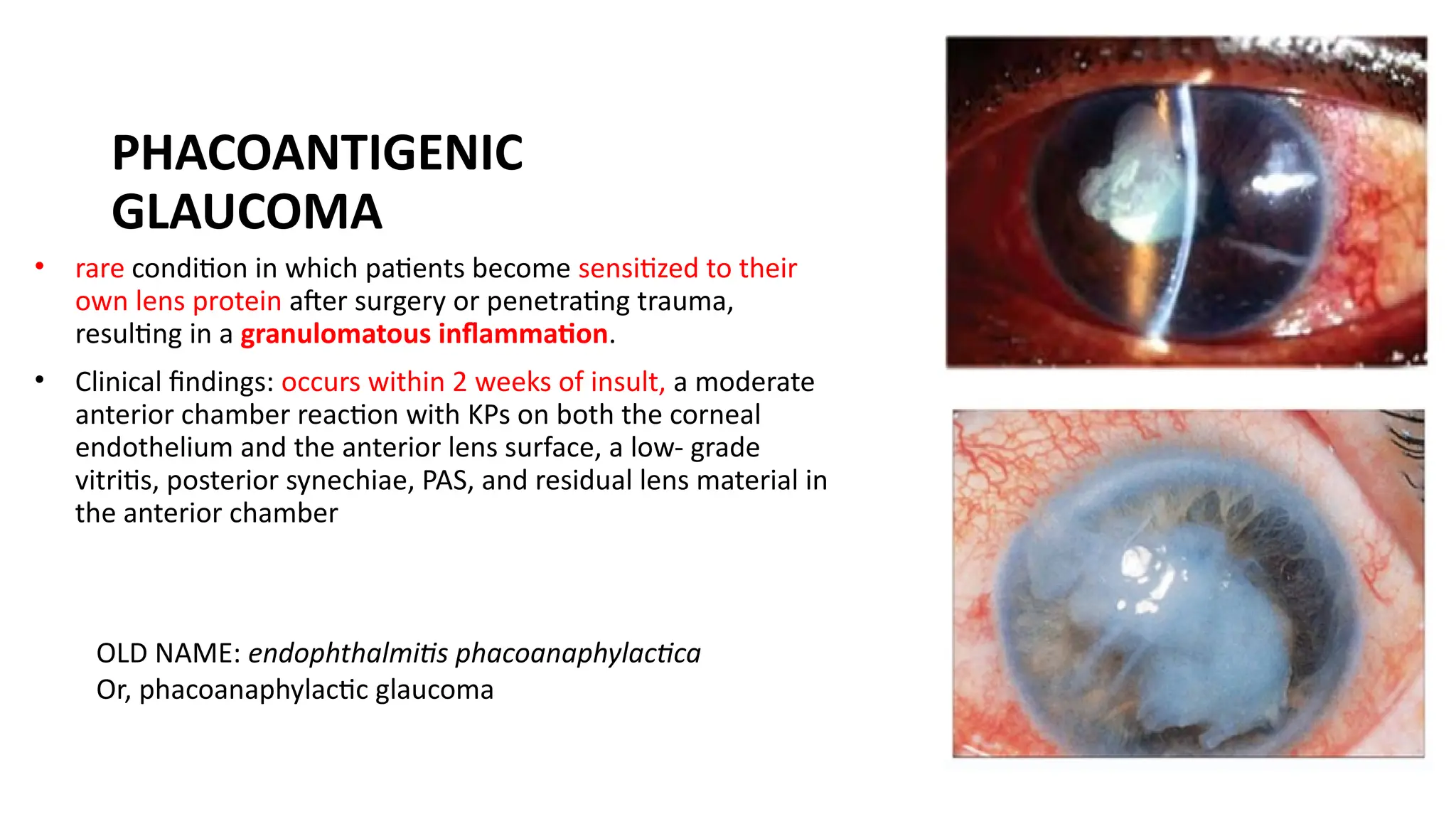 LENS INDUCED GLAUCOMA for Ophthalmology.pptx