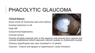 Phacolytic Glaucoma
