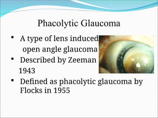 Lens Induced glaucoma caused by lens pathology | PPT