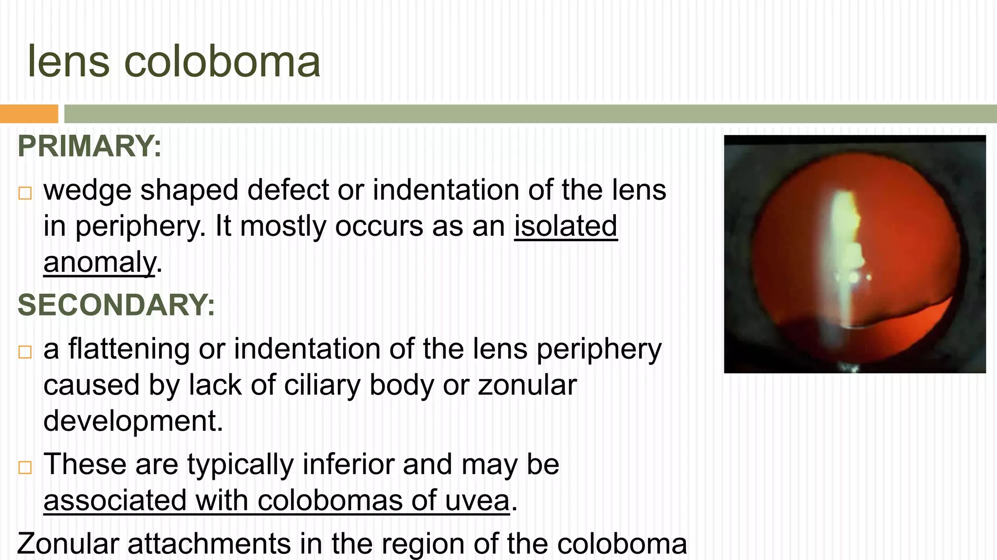 Lens anatomy and physiology with clinical correlation | PPTX