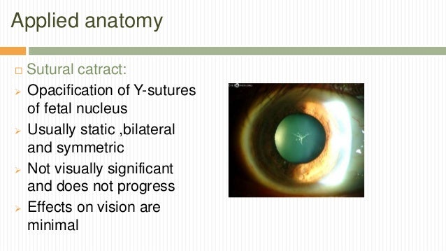 Lens anatomy and physiology with clinical correlation