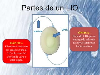 Lentes intraoculares | PPTX