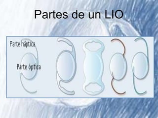 Lentes intraoculares | PPTX