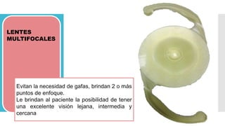 Lentes intraoculares (lio) | PPTX