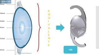 Lentes intraoculares (lio) | PPTX